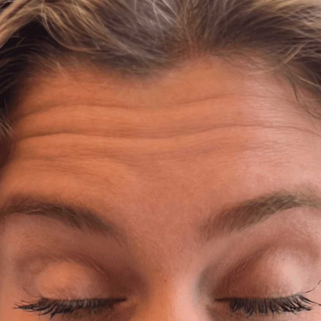 The Best Botox Naples FL | Facial Injection Treatments - The Wellness ...