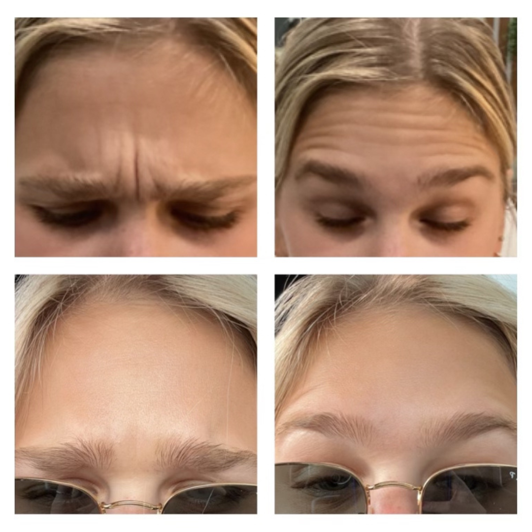 The Best Botox Naples FL | Facial Injection Treatments - The Wellness ...