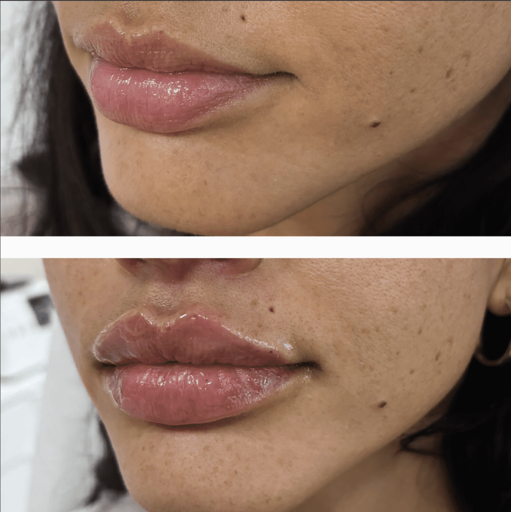 The Best Lip Injections Naples FL | The Wellness Lab