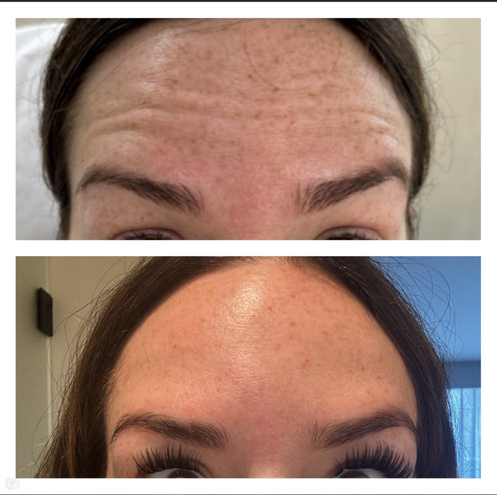 Botox Treatments in Naples, FL